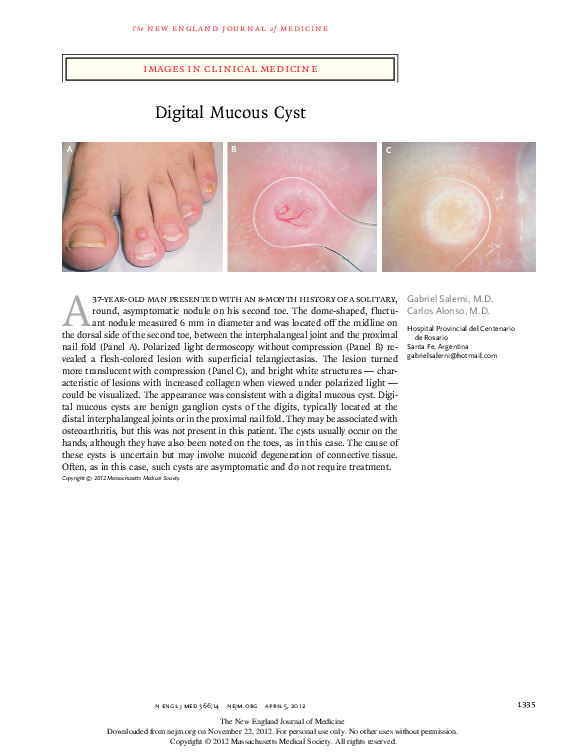(PDF) Digital Mucous Cyst