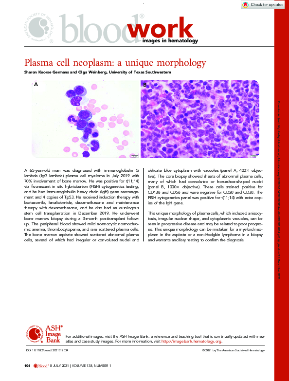 (PDF) Plasma cell neoplasm: a unique morphology