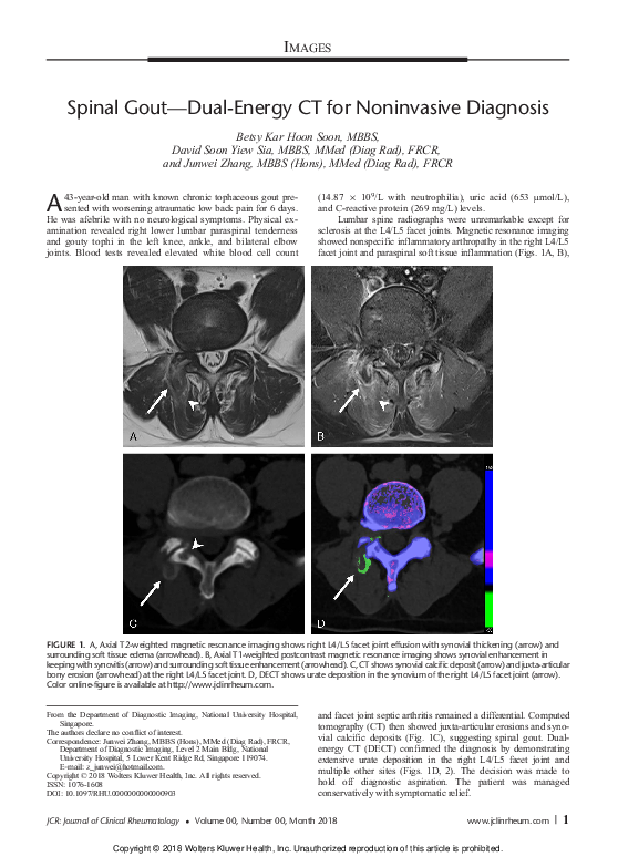 (PDF) Spinal Gout—Dual-Energy CT for Noninvasive Diagnosis
