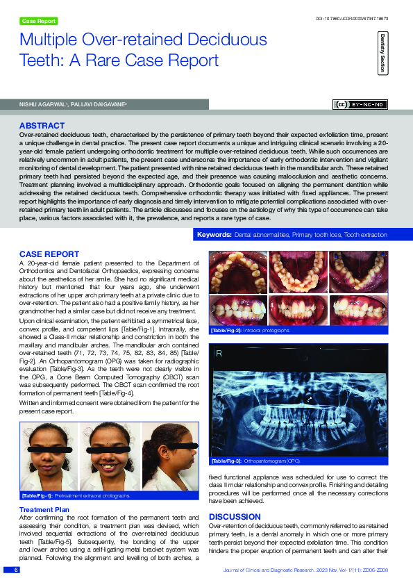(PDF) Multiple Over-retained Deciduous Teeth: A Rare Case Report