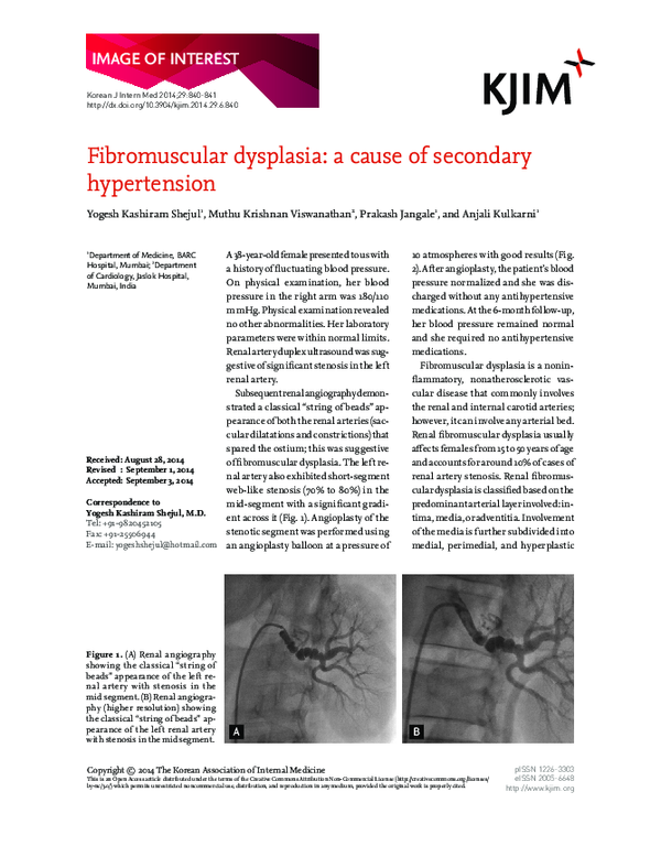 (PDF) Fibromuscular dysplasia: a cause of secondary hypertension