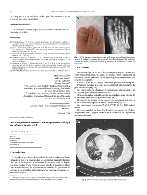 (PDF) Carcinome pulmonaire occulte à cellules squameuses révélé par une ...
