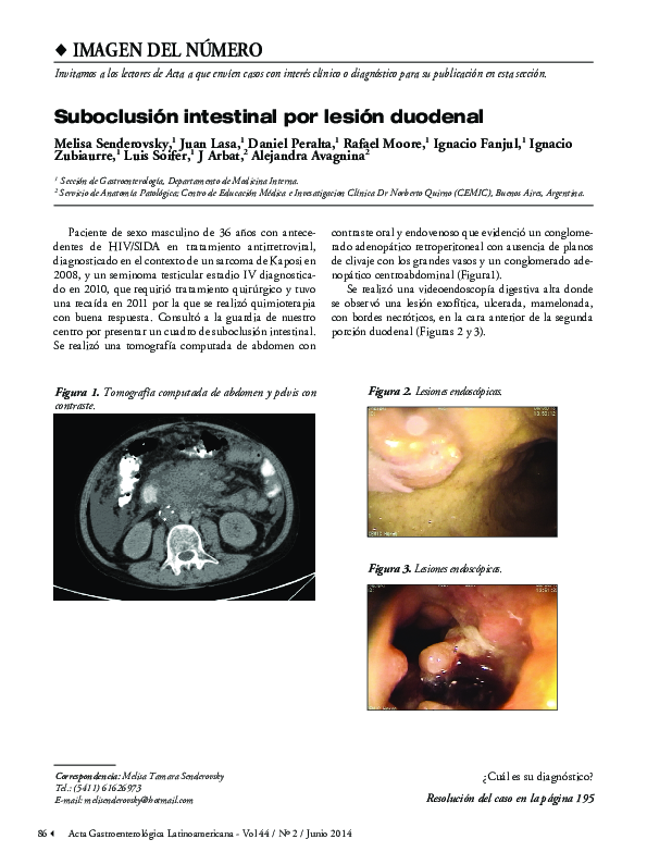 (PDF) Suboclusión intestinal por lesión duodenal