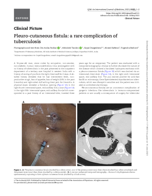 (PDF) Pleuro-cutaneous fistula: a rare complication of tuberculosis
