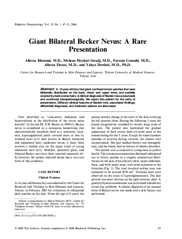 (PDF) Giant Bilateral Becker Nevus: A Rare Presentation