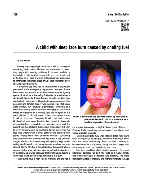 (PDF) A child with deep face burn caused by chafing fuel