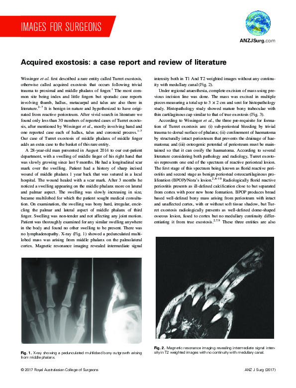 (PDF) Acquired exostosis: a case report and review of literature | chandrakanta Nayak - Academia.edu