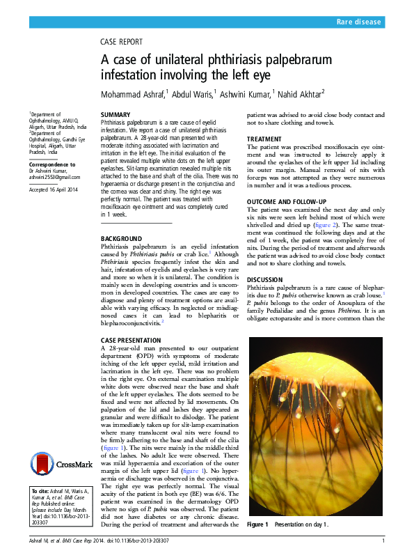 (PDF) A case of unilateral phthiriasis palpebrarum infestation ...