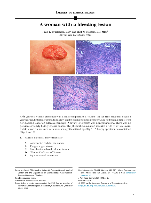(PDF) A woman with a bleeding lesion
