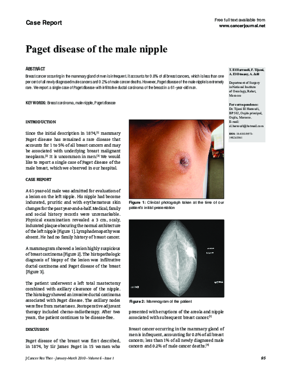 (PDF) Paget disease of the male nipple | Tijani El Harroudi - Academia.edu