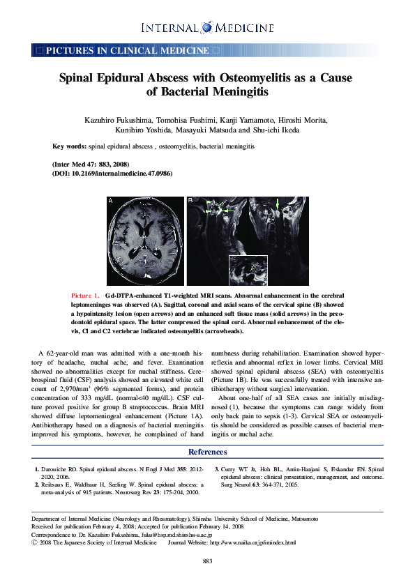 (PDF) Spinal Epidural Abscess with Osteomyelitis as a Cause of ...