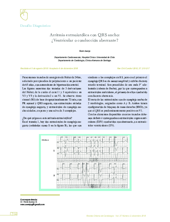 (PDF) Arritmia extrasistólica con QRS ancho: ¿Ventricular o conducción ...