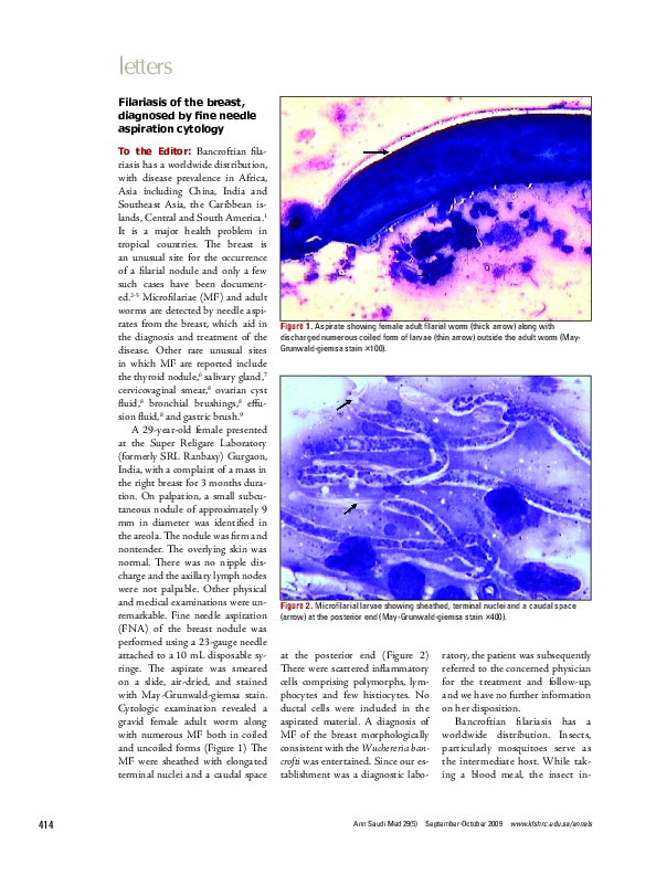 (PDF) Filariasis of the Breast, Diagnosed by Fine Needle Aspiration ...