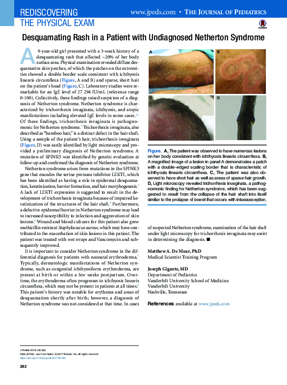 (PDF) Desquamating Rash in a Patient with Undiagnosed Netherton ...