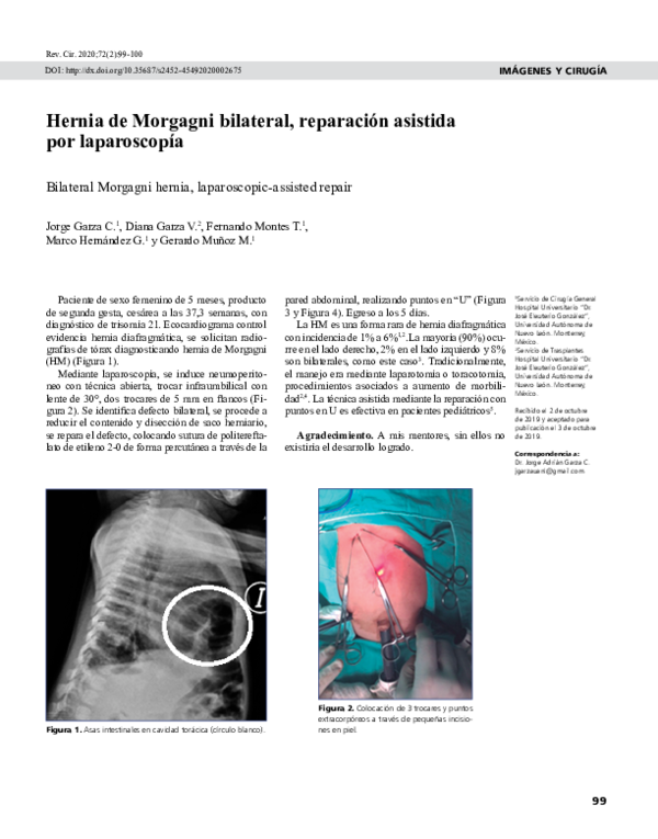 (PDF) Hernia de Morgagni bilateral, reparación asistida por laparoscopia