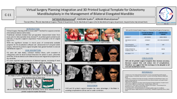 (PDF) Virtual Surgery Planning Integration and 3D Printed Surgical ...