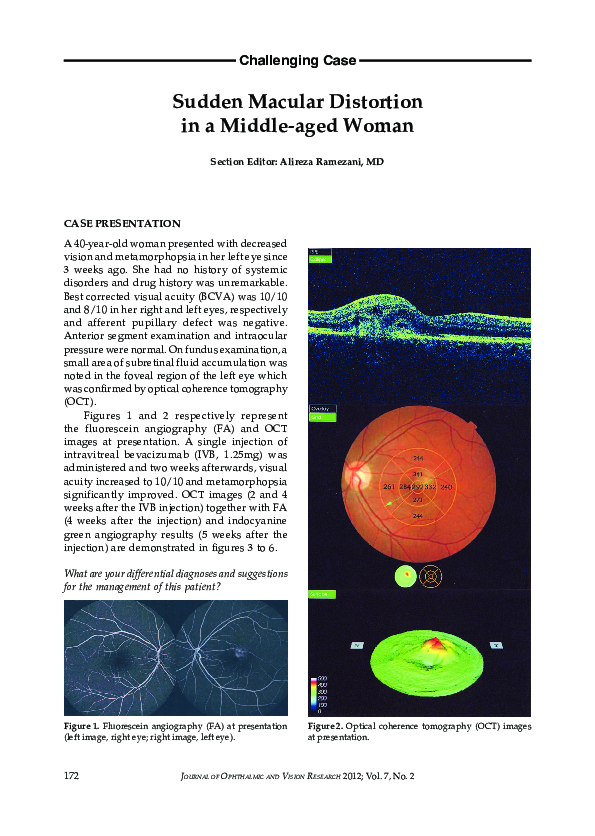 (PDF) Sudden Macular Distortion in a Middle-aged Woman | Reza Karkhaneh ...
