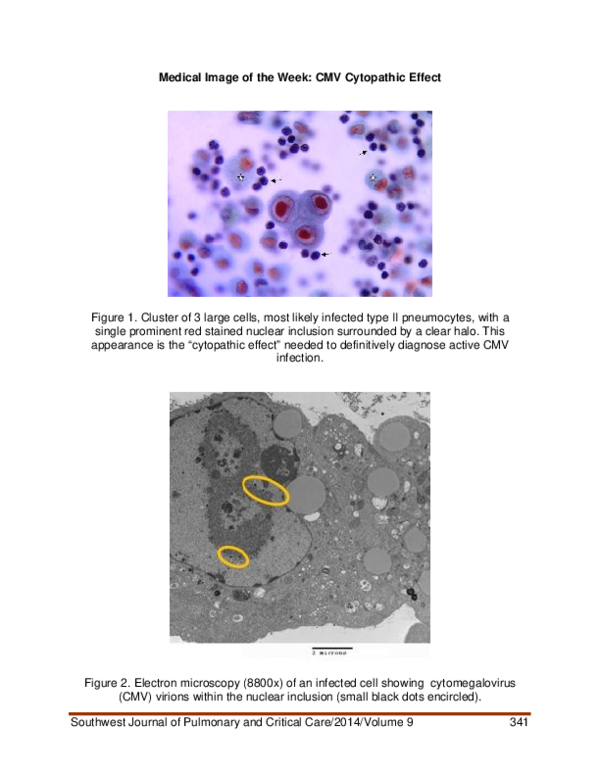 (PDF) Medical image of the week: CMV cytopathic effect | Afshin Sam ...