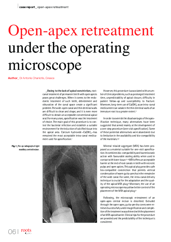 (PDF) Open Apex Retreatment Under the Operating Microscope