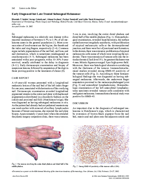 Pdf Early Diagnosed But Late Treated Subungual Melanoma