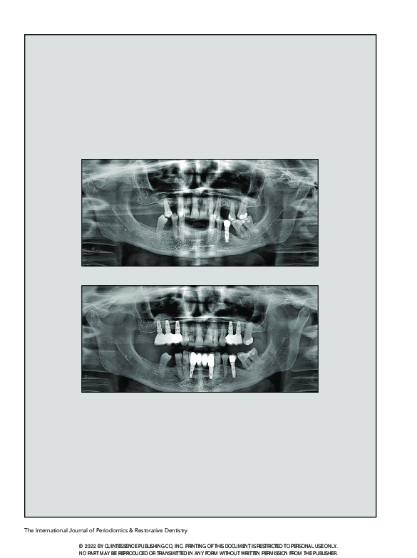 (PDF) Low Window Sinus Elevation Technique: Bone Gain and Postsurgical ...
