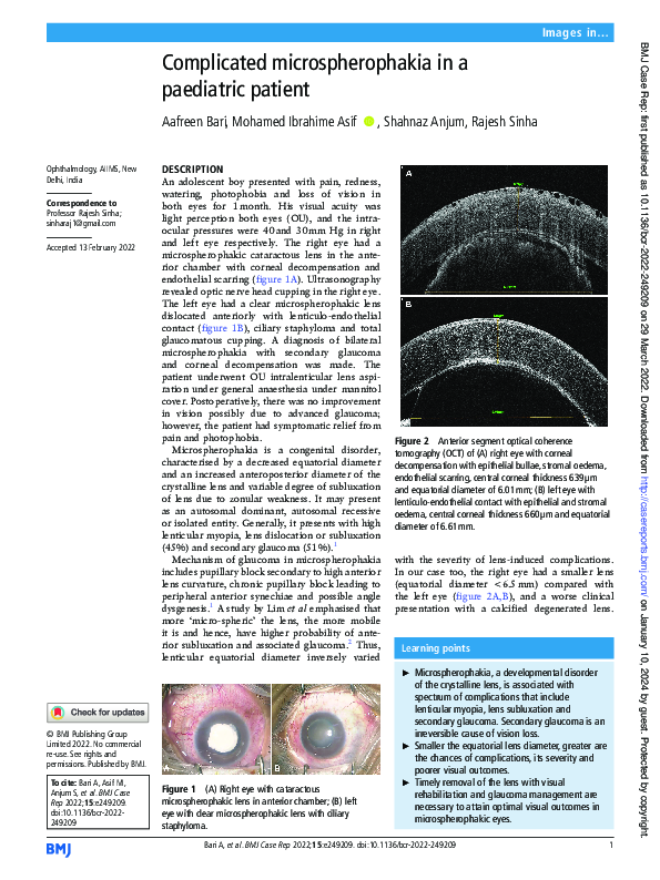 (PDF) Complicated microspherophakia in a paediatric patient