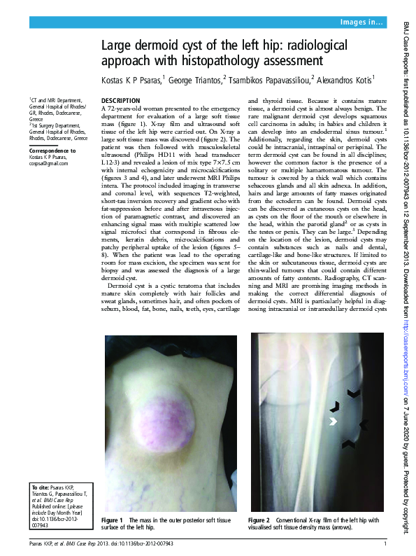 (PDF) Large dermoid cyst of the left hip: radiological approach with ...