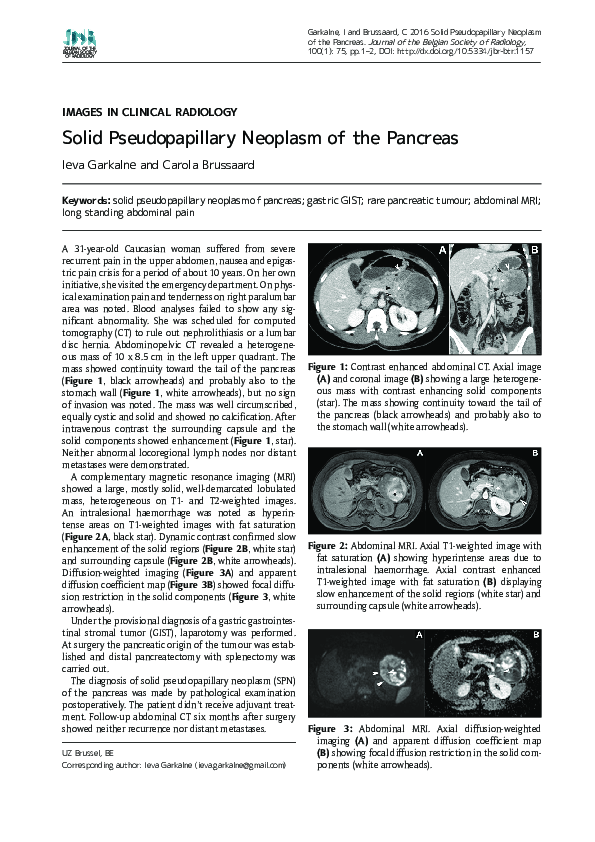 (PDF) Solid Pseudopapillary Neoplasm of the Pancreas