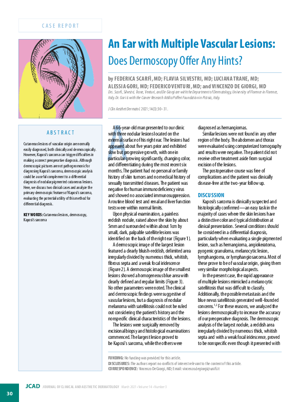 (PDF) An Ear with Multiple Vascular Lesions: Does Dermoscopy Offer Any ...