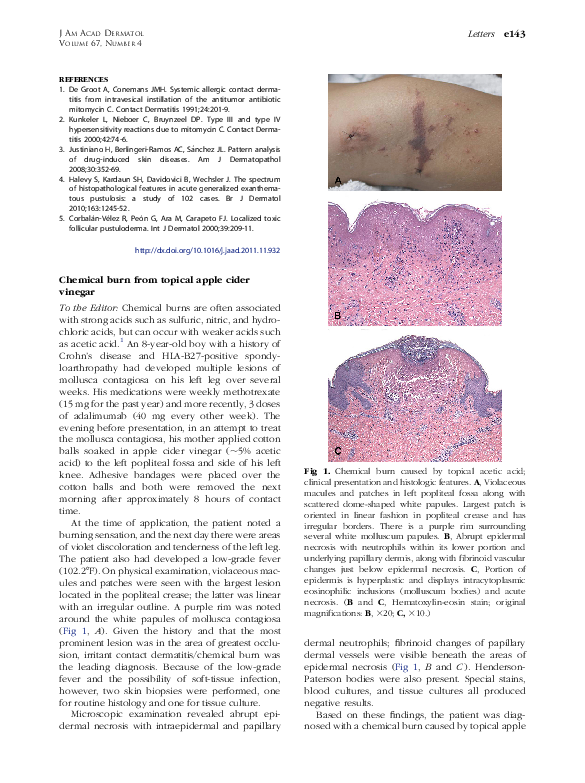 (PDF) Chemical burn from topical apple cider vinegar