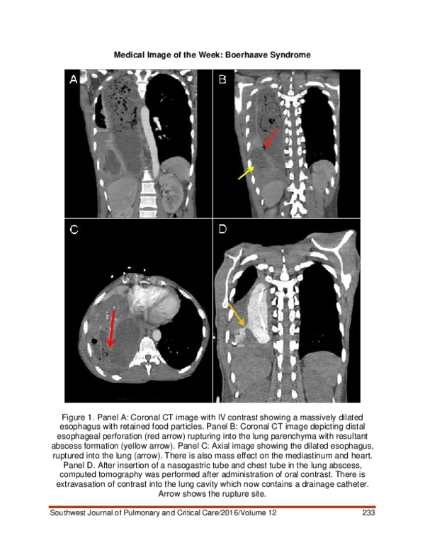 (PDF) Medical image of the week: Boerhaave syndrome