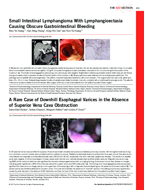 (PDF) A Rare Case of Downhill Esophageal Varices in the Absence of ...