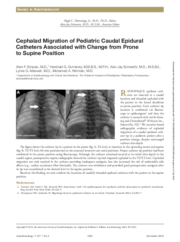 (PDF) Cephalad Migration of Pediatric Caudal Epidural Catheters ...