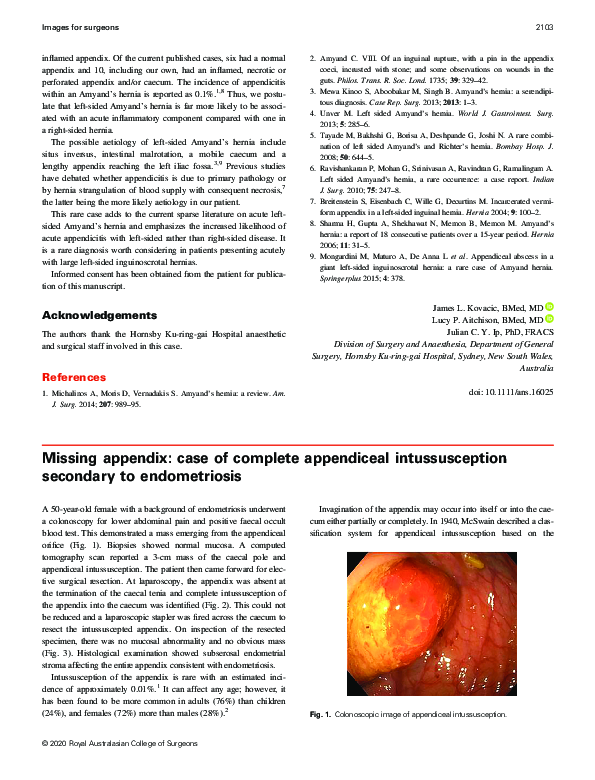 (PDF) Missing appendix: case of complete appendiceal intussusception ...