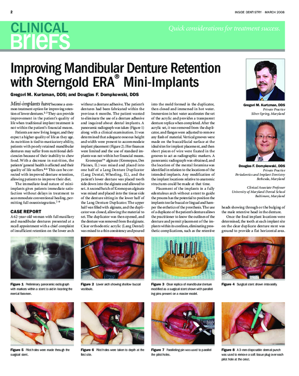 (PDF) Improving Mandibular Denture Retention with Sterngold ERA ® Mini ...