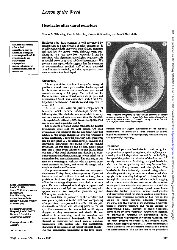 (PDF) Headache after dural puncture