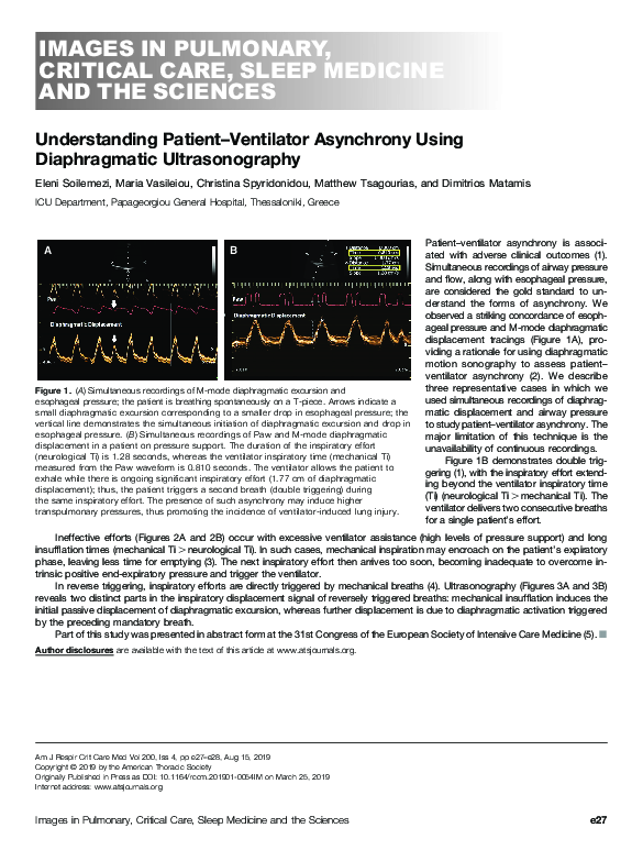 (PDF) Understanding Patient–Ventilator Asynchrony Using Diaphragmatic Ultrasonography