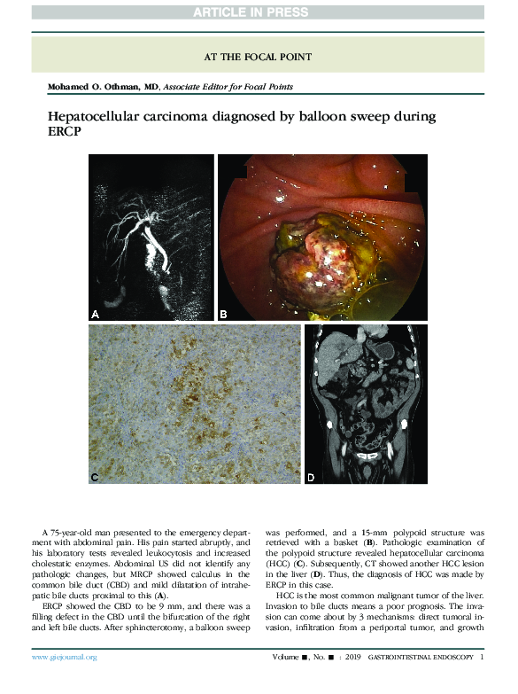 (PDF) Hepatocellular Carcinoma Diagnosed by Balloon Sweep During ERCP