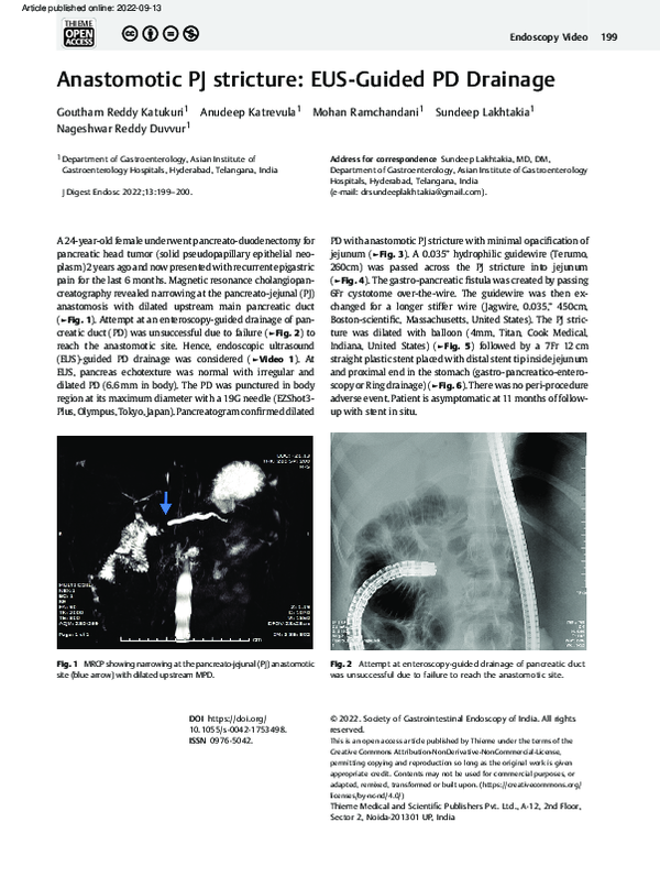 (PDF) Anastomotic PJ stricture: EUS-Guided PD Drainage