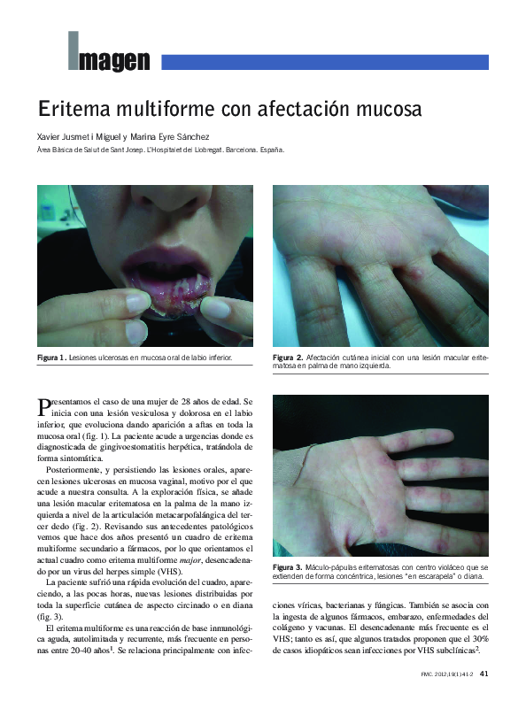 (PDF) Eritema multiforme con afectación mucosa