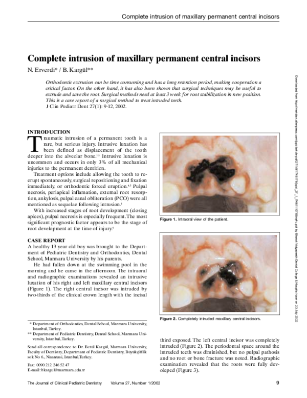 (PDF) Complete intrusion of maxillary permanent central incisors
