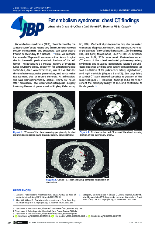 (PDF) Fat embolism syndrome: chest CT findings