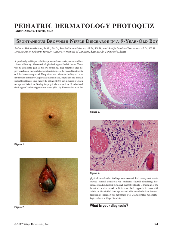 (PDF) Spontaneous Brownish Nipple Discharge in a 9‐Year‐Old Boy