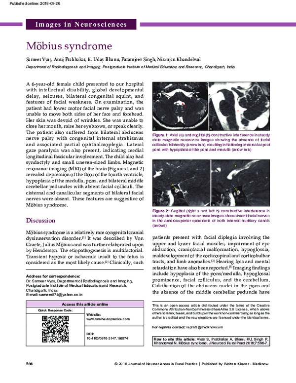 (PDF) Möbius syndrome