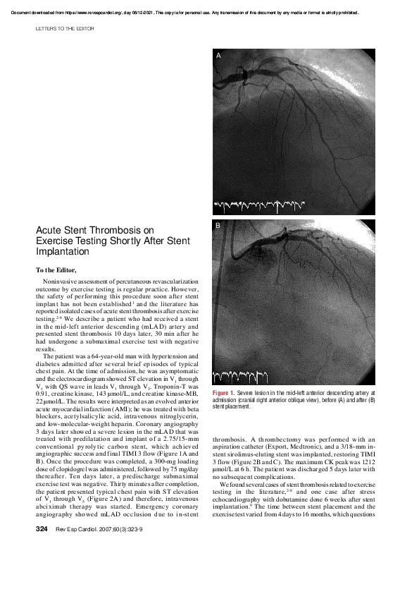 (PDF) Acute Stent Thrombosis on Exercise Testing Shortly After Stent ...