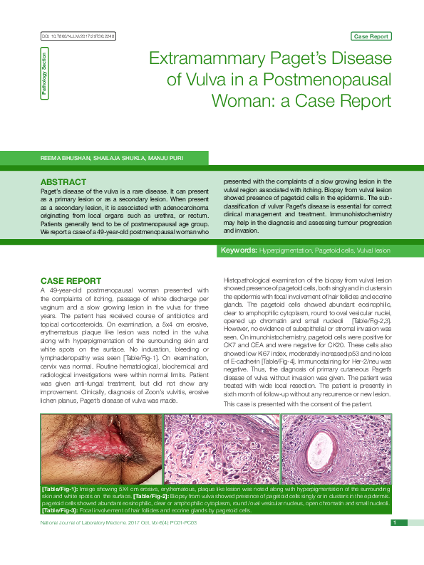 (PDF) Extramammary Paget's Disease of Vulva in a Postmenopausal Woman ...