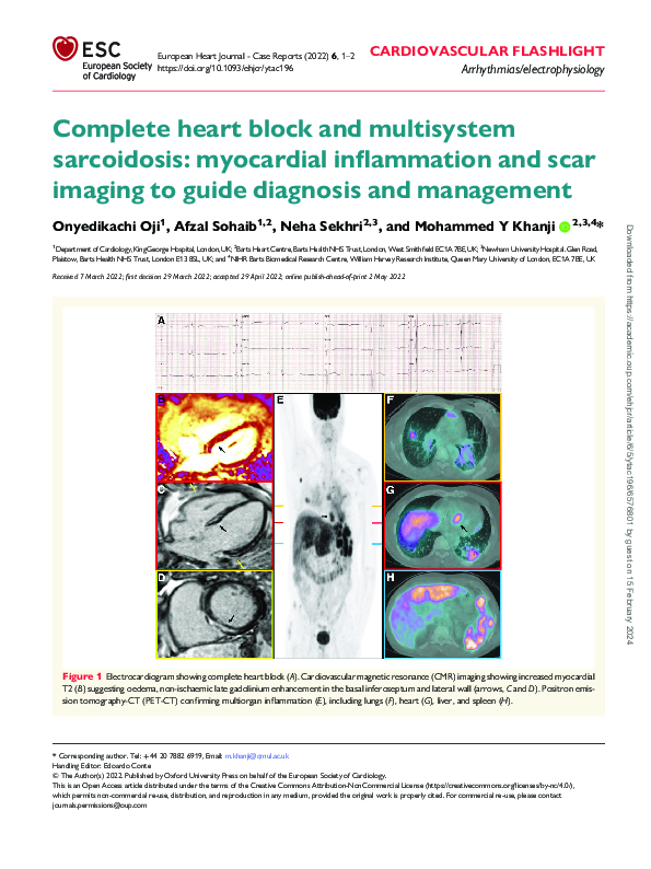 (PDF) Complete heart block and multisystem sarcoidosis: myocardial ...