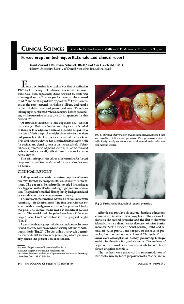(PDF) Forced eruption technique: Rationale and clinical report