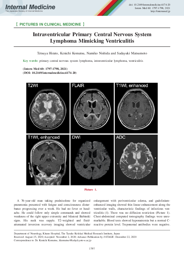 (PDF) Intraventricular Primary Central Nervous System Lymphoma Mimicking Ventriculitis