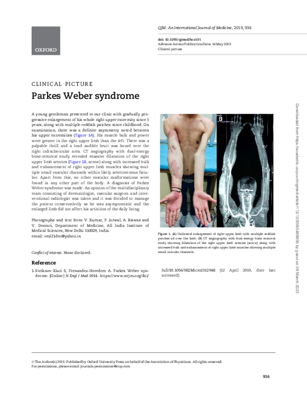 (PDF) Parkes Weber syndrome